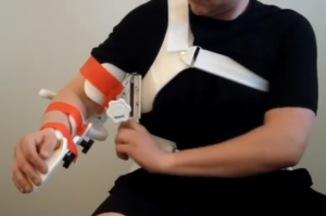 Joint Contracture Treatment, Research & Support | JC.org